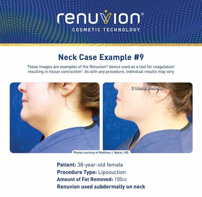 Renuvion Skin Tightening Pasadena, CA - Dr. Nima Plastic Surgery