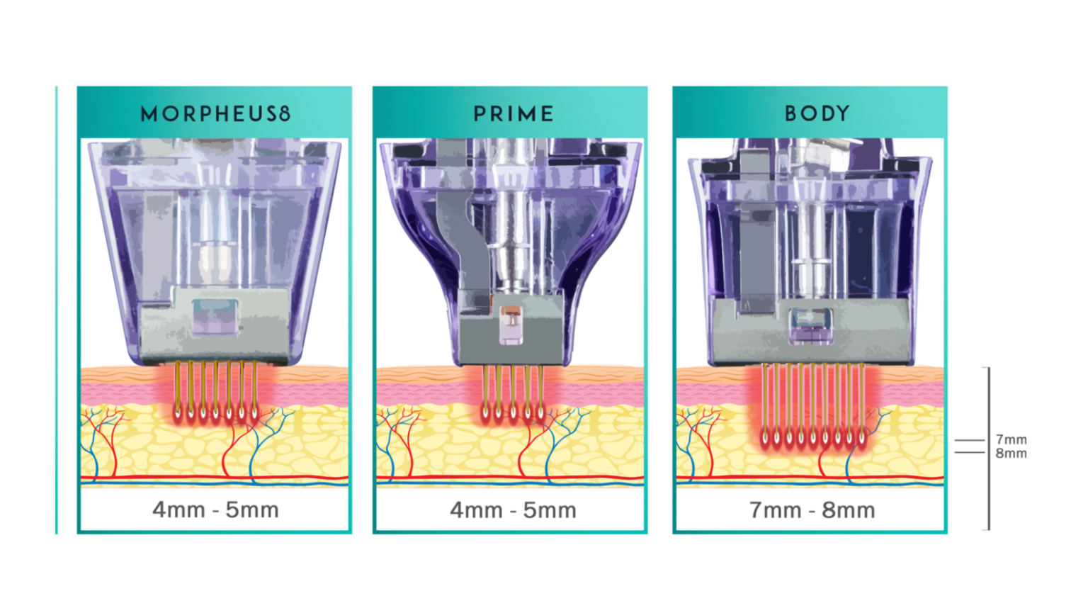 Morpheus8 Pasadena, CA - RF Microneedling Skin Treatment