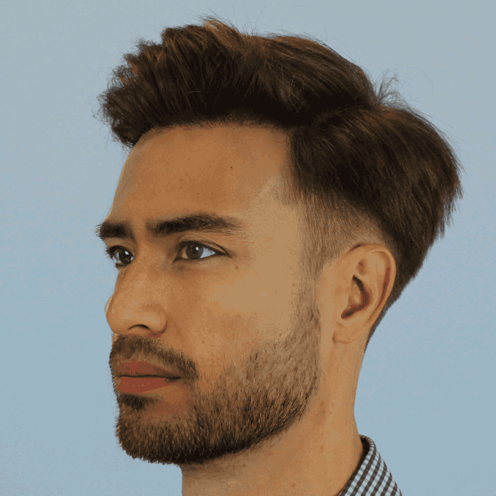 Hair Transplant Chicago – Hairline & Beard Restoration Chicago