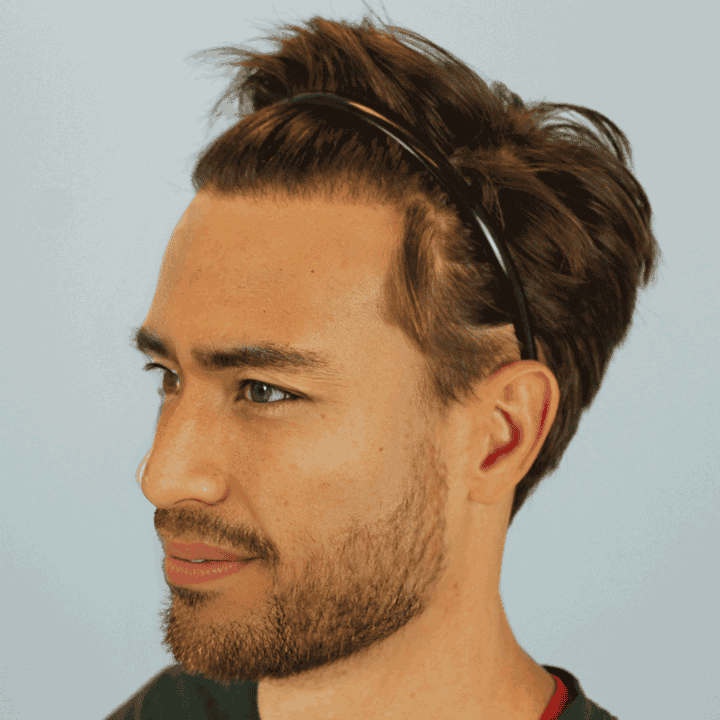 Hair Transplant Chicago – Hairline & Beard Restoration Chicago