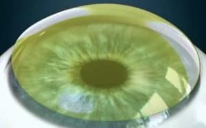 3 Reasons Why You Should Get Holcomb C3-R® Procedure