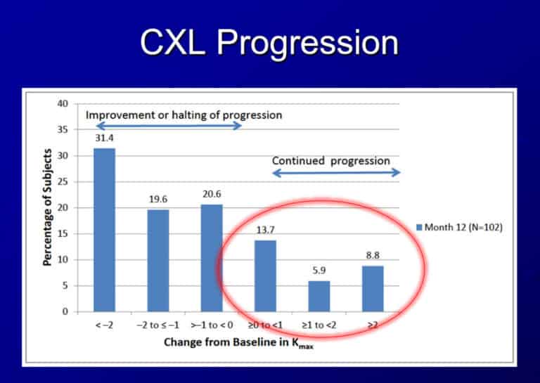 C3-R Corneal Cross-Linking CXL Los Angeles - Keratoconus Treatment
