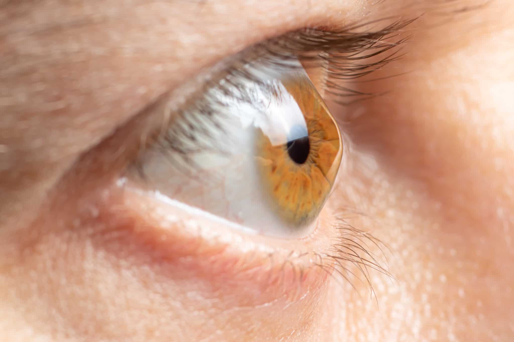 What Happens If You Avoid Treating Keratoconus Bay Area Eye Specialist