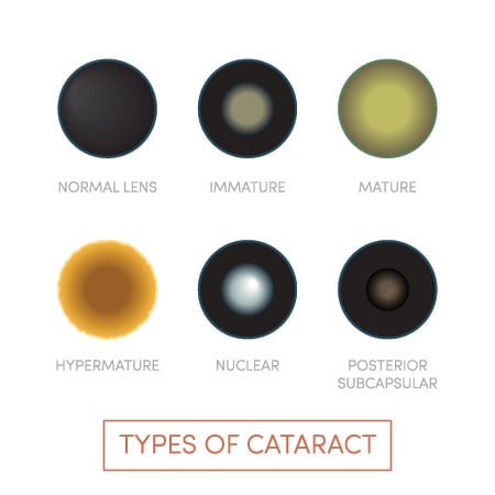 Cataract Surgery Bay Area - Advanced Eye Care Castro Valley