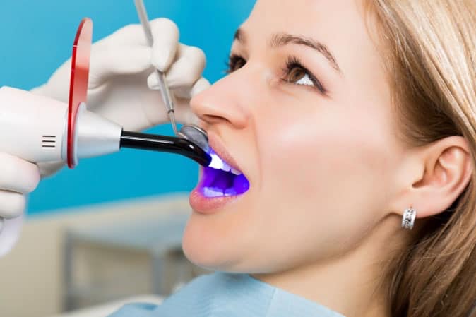 Dental Bonding Beverly Hills - Composite Dental Bonding
