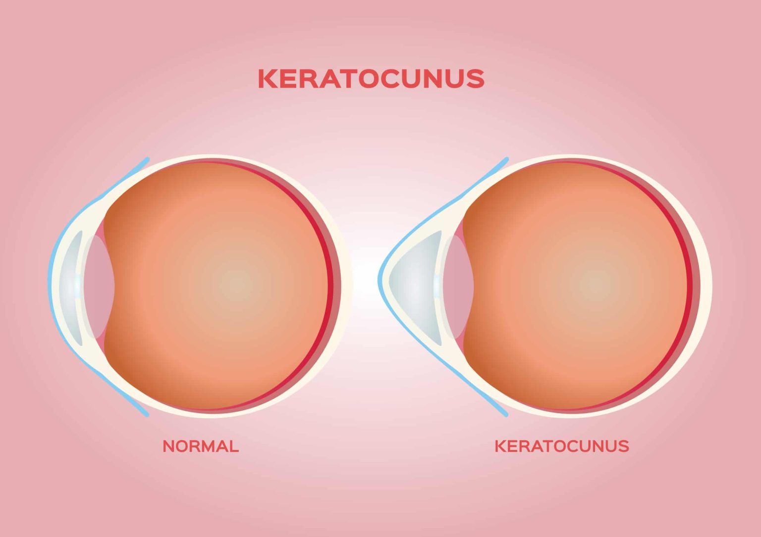 The Dangers of Ignoring Keratoconus - TRES VISION Group